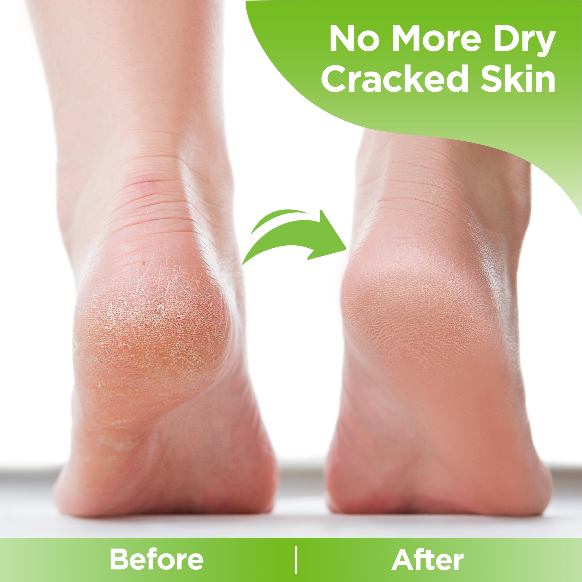 Natural Foot, Hand & Body Rescue Balm - Tea Tree – Rocket Pure